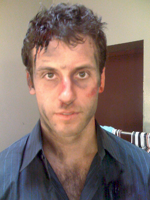 How To Broken Nose Makeup | Saubhaya Makeup